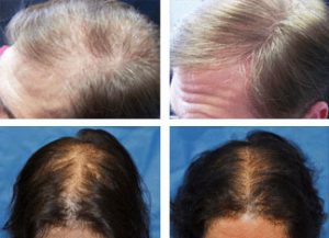 Hair Loss in Men: The Beard Paradox of Facial Hair & Balding